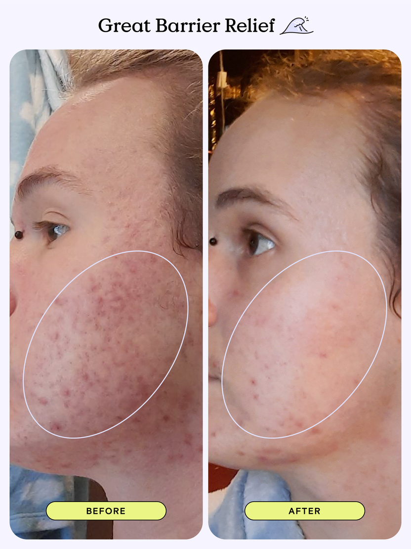 Jumbo Great Barrier Relief: Skin Barrier Restoring Serum – KraveBeauty